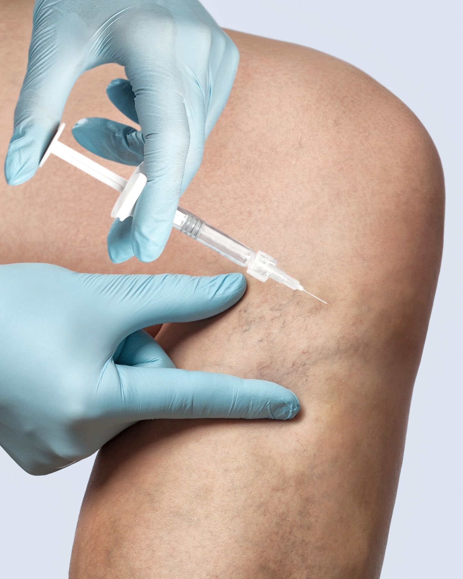 Vein Injection - Sclerotherapy - Meridian Cosmetic