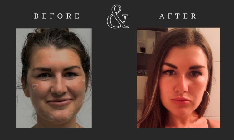 PDO Thread Face Lift - Meridian Cosmetic PDO Thread Face Lift