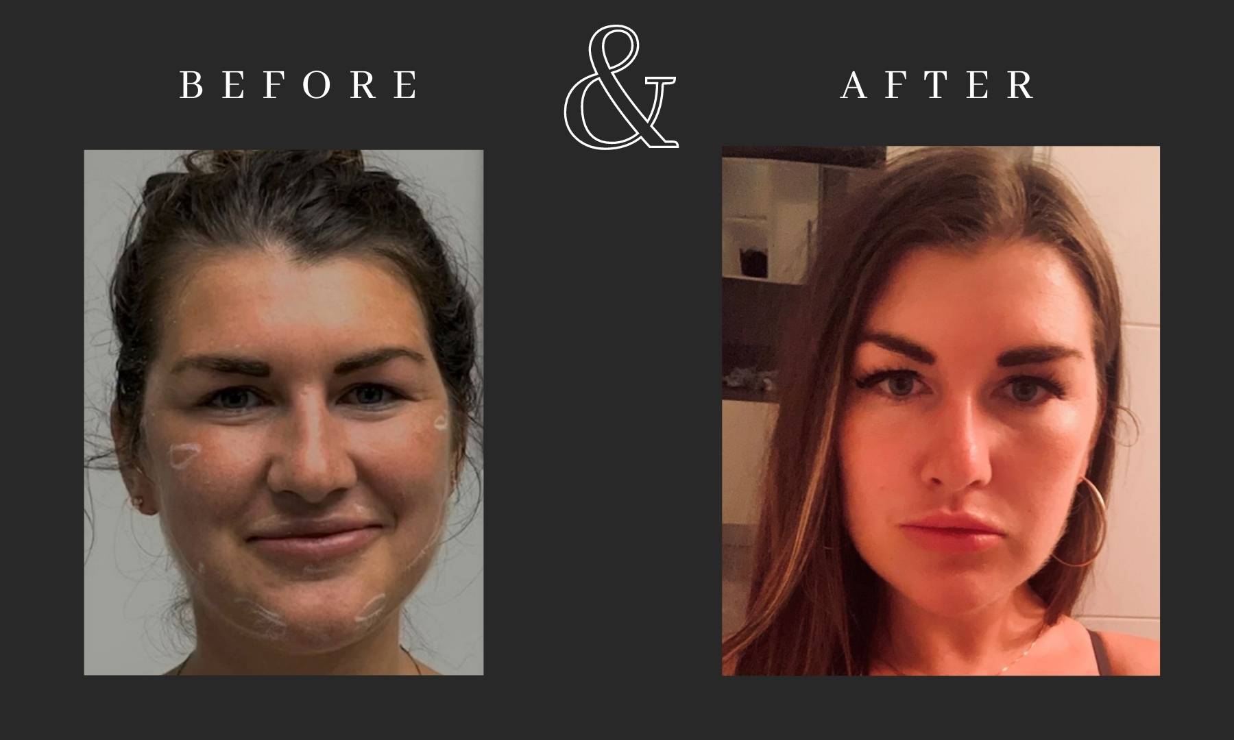 PDO Thread Face Lift - Meridian Cosmetic PDO Thread Face Lift