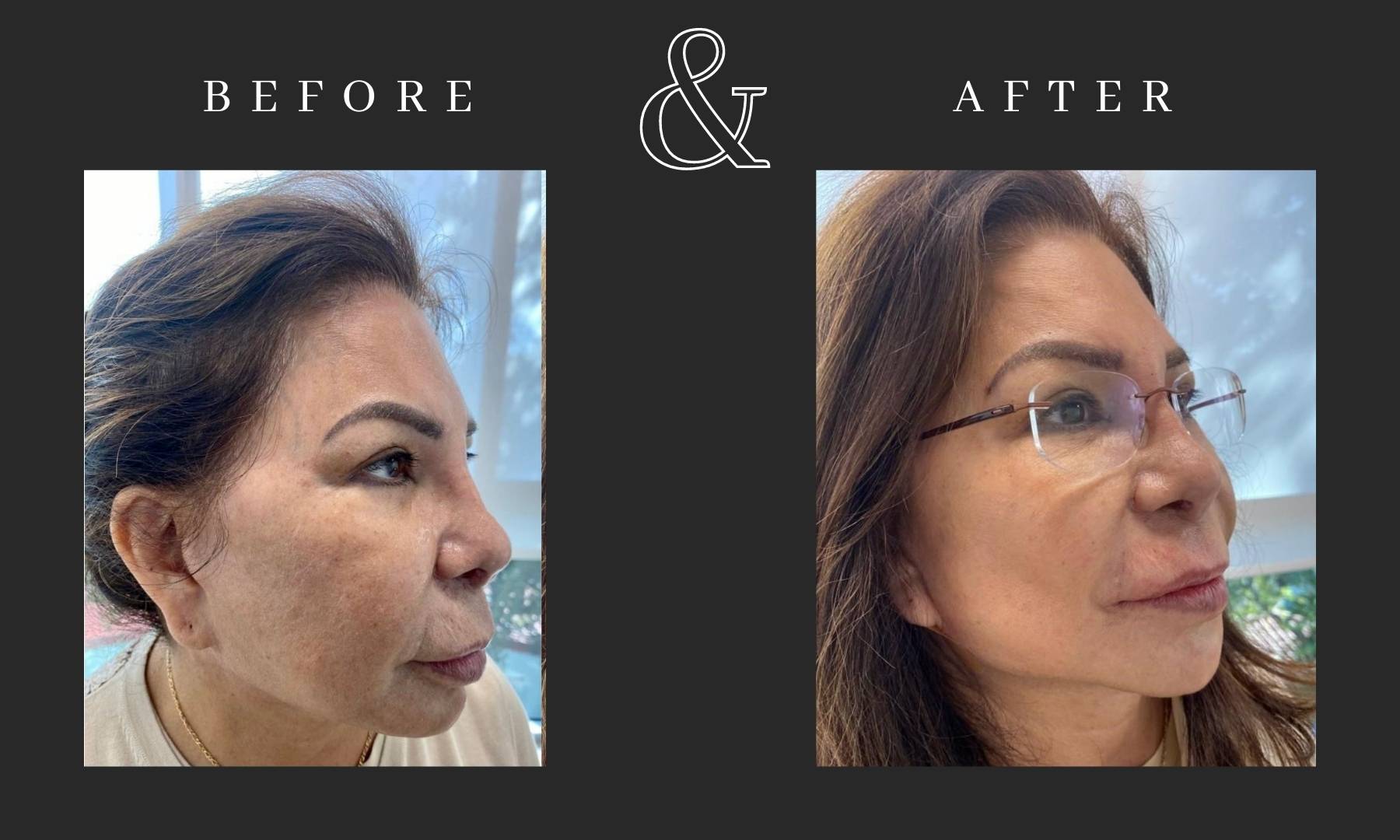 PDO Thread Face Lift - Meridian Cosmetic PDO Thread Face Lift