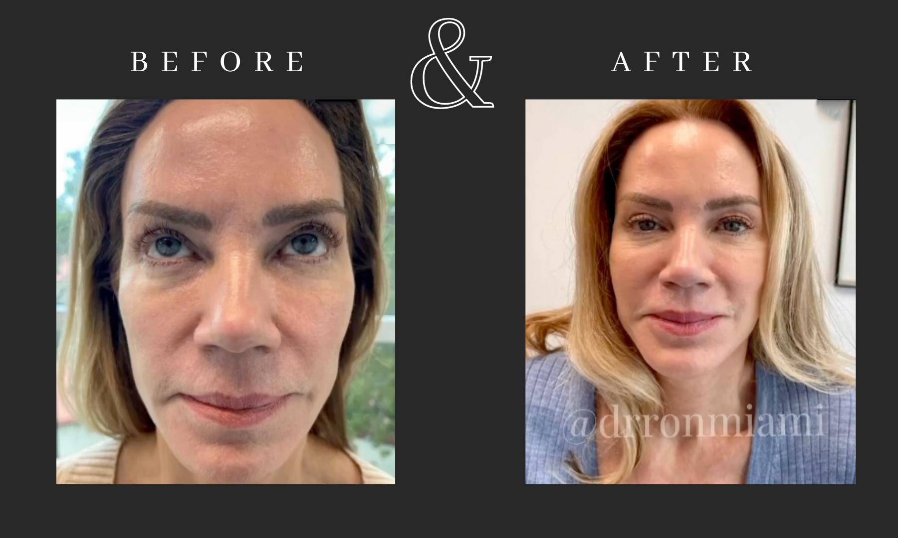 PDO Thread Face Lift - Meridian Cosmetic PDO Thread Face Lift