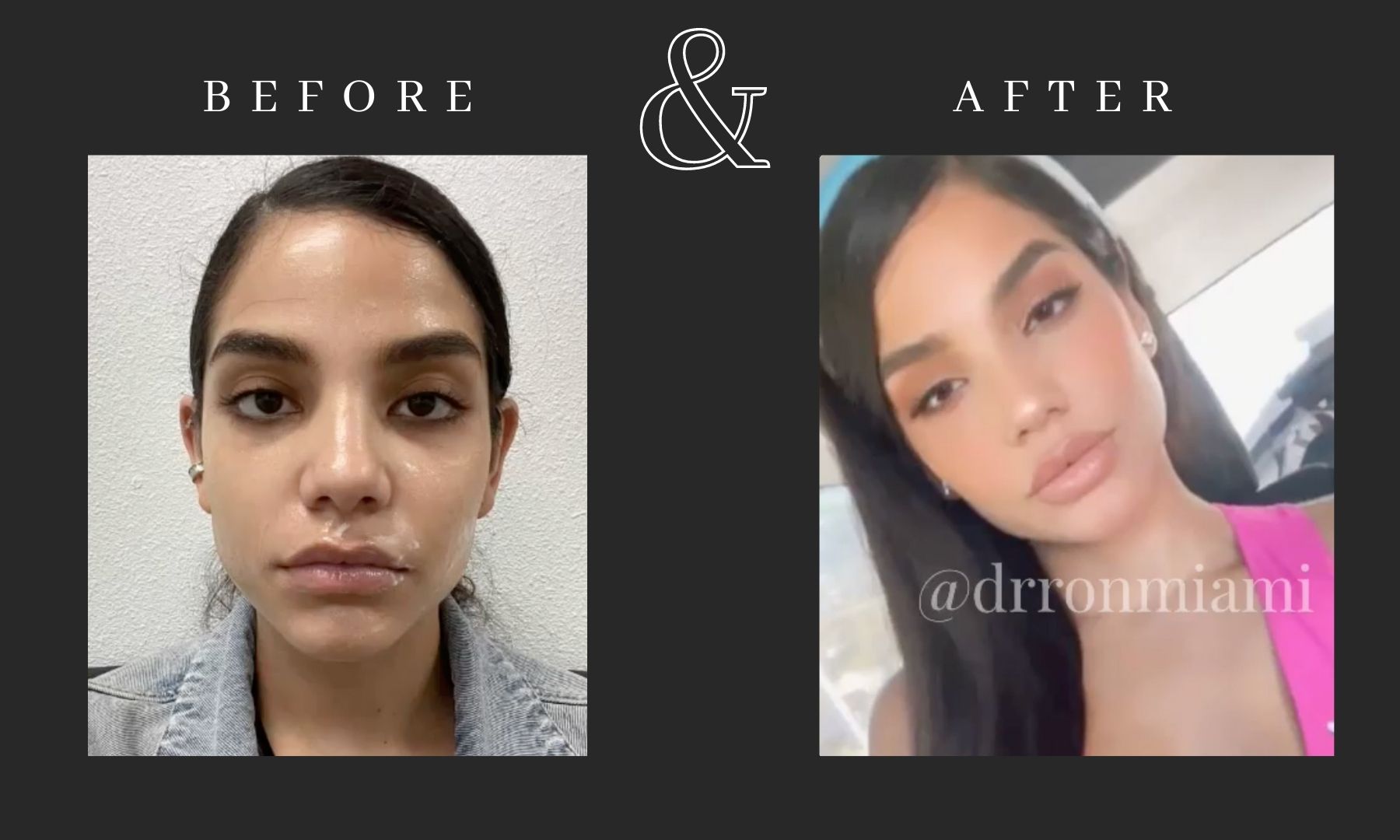 PDO Thread Face Lift - Meridian Cosmetic PDO Thread Face Lift